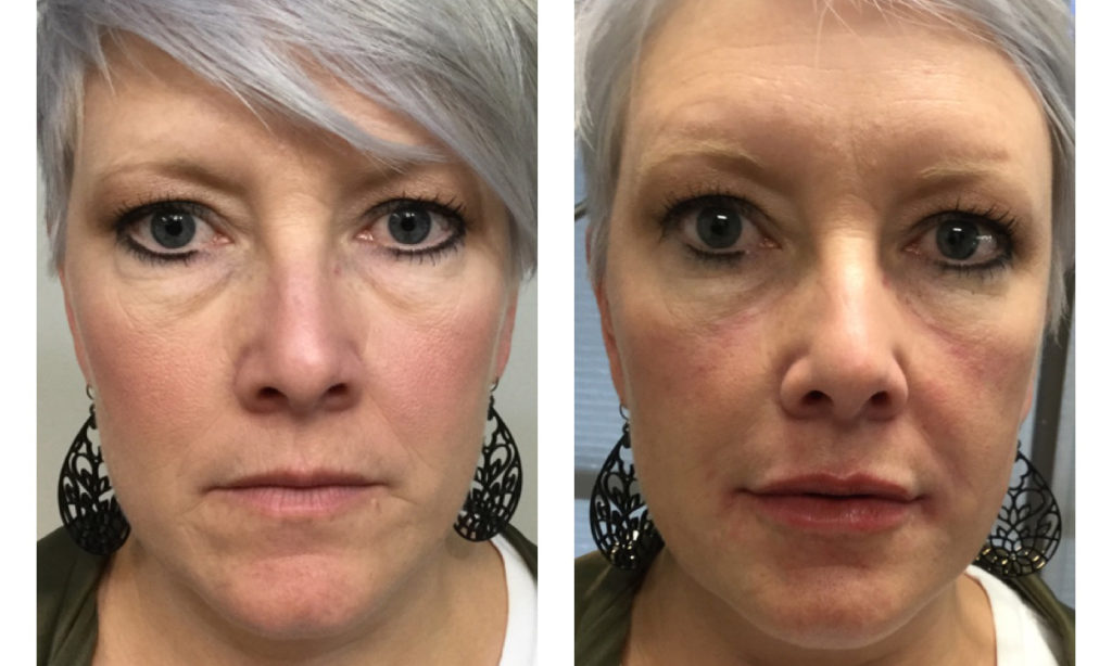 Volbella Dermal Filler| Style MedSpa