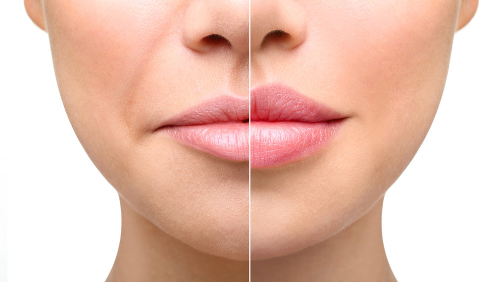 Volbella Dermal Filler| Style MedSpa