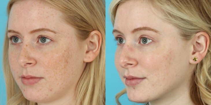 RevePeel | Get Hair Less