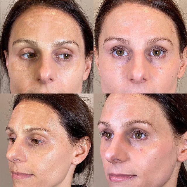 RevePeel | Get Hair Less