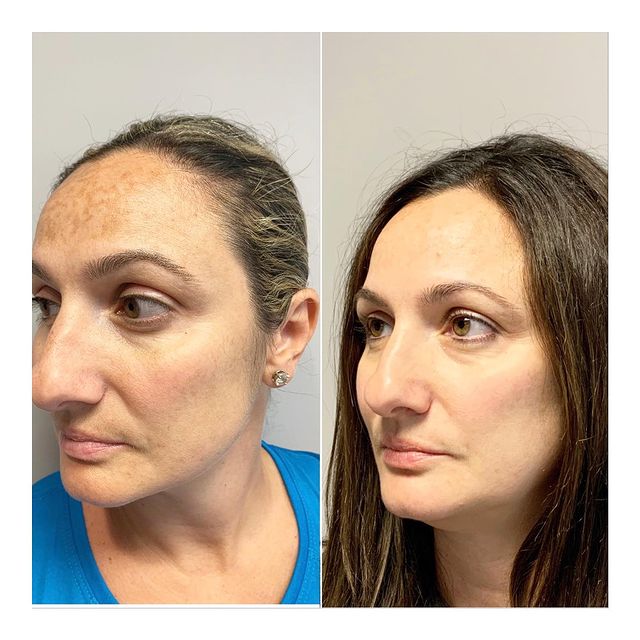 RevePeel | Get Hair Less