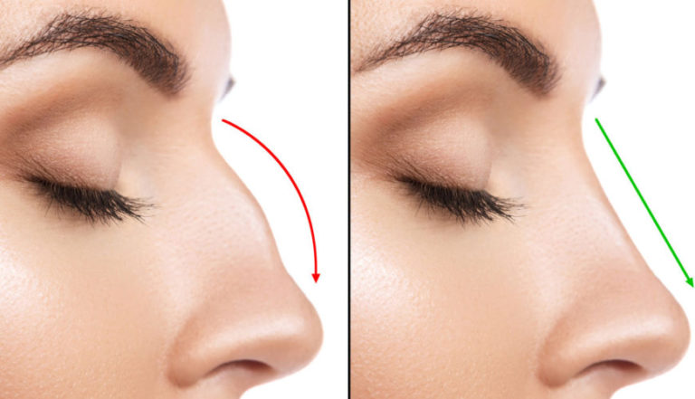 Liquid Nose Job Lift - Immediate Results No more nose bumps